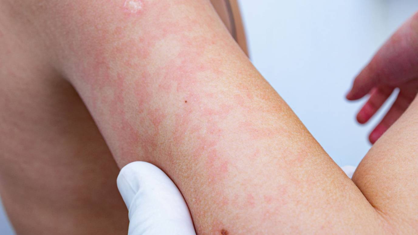 Large Study Finds Children with Skin Diseases Suffer Stigma, Bullying ...