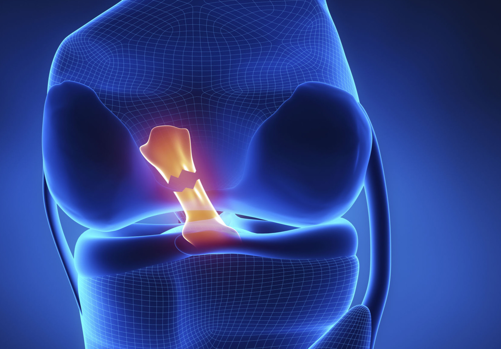The Size of Your Meniscus Matters: Knee Pain Explained - - Prova Education
