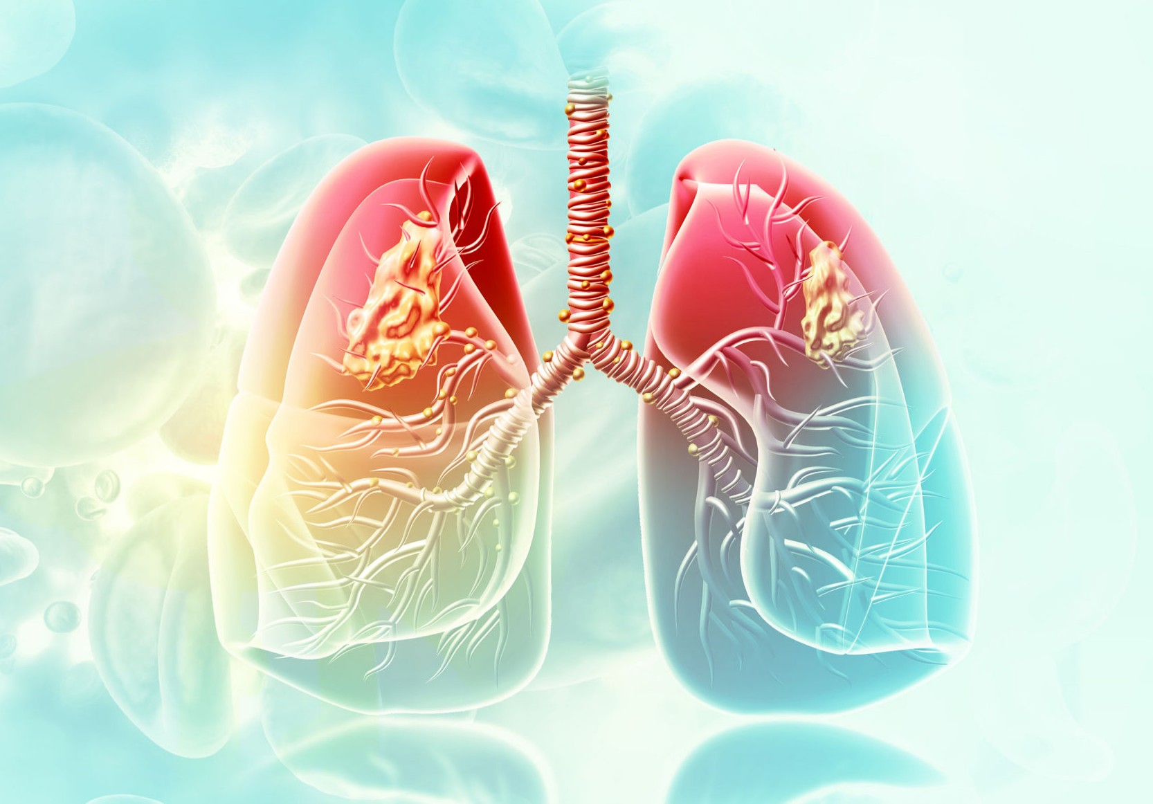 Newly Discovered Genetic Malfunction Causes Rare Lung Disease - - Prova ...